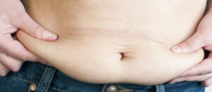 Removing Loose Skin after Weight Loss - Beverly Hills Physicians